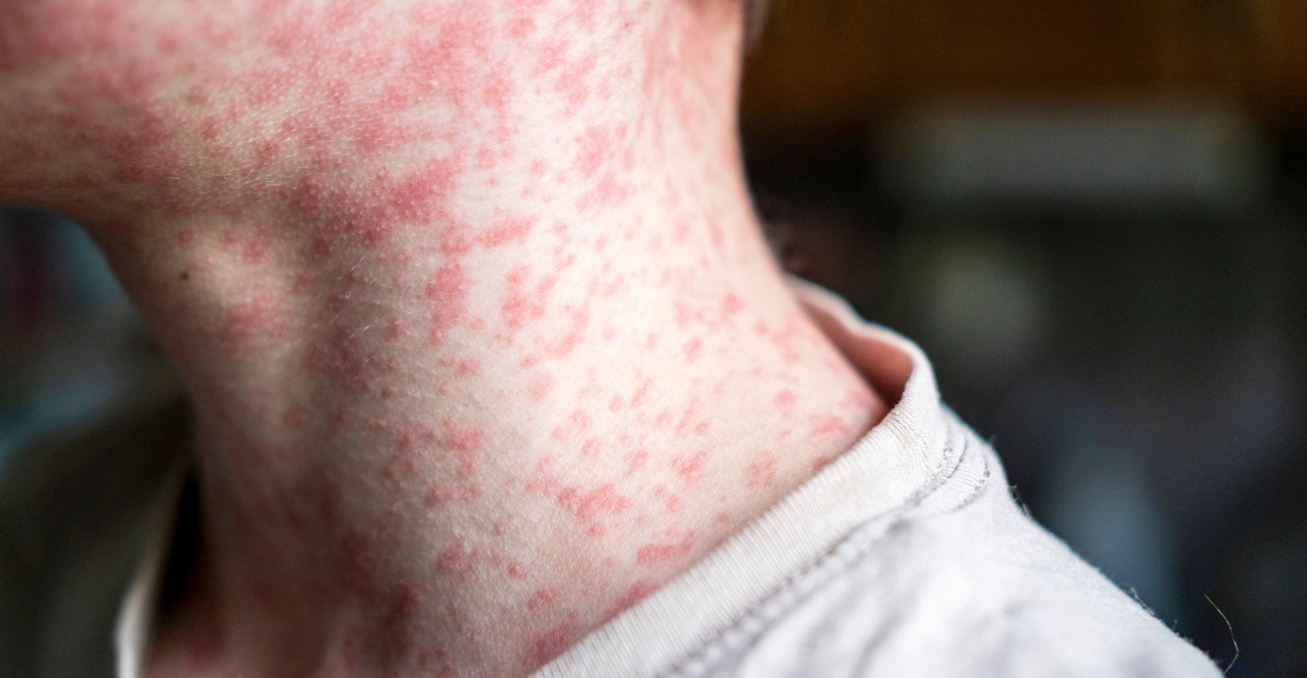 Measles Outbreak: Everything You Need to Know About Measles and the MMR Vaccine | Tallahassee ...